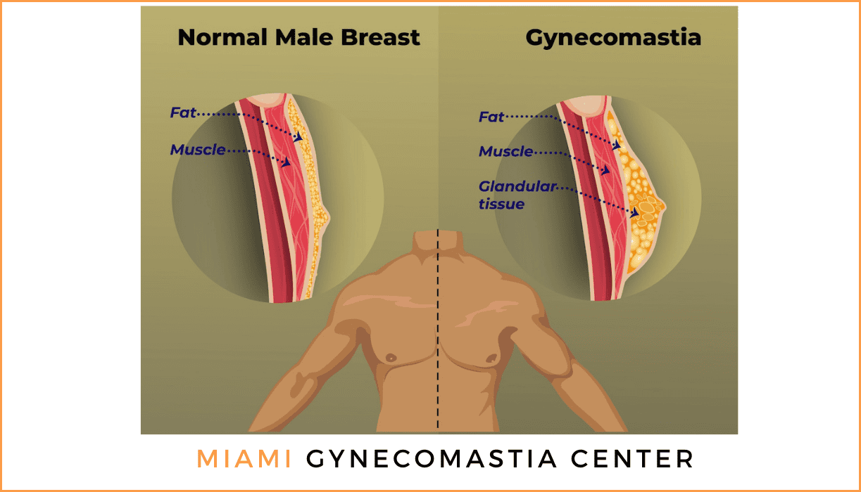 What is Gynecomastia Overview (Miami Gynecomastia Center)
